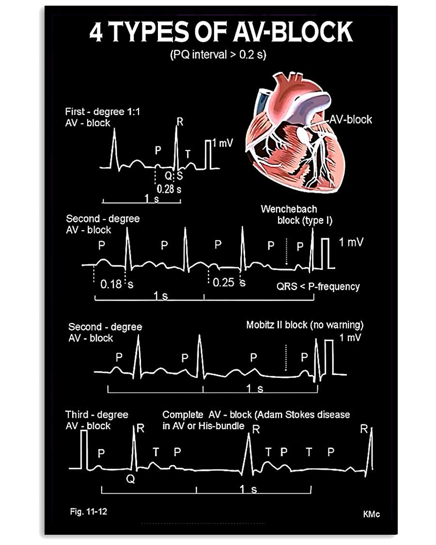 Ecg Heart Four Types Of Av-Block Cardiologist Portrait Poster & Canvas ...